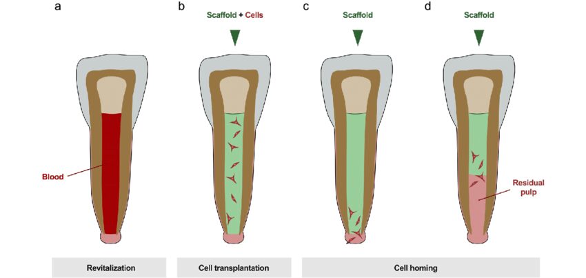 Regenerative Endodontics: Sprouting Life - Gop Convention